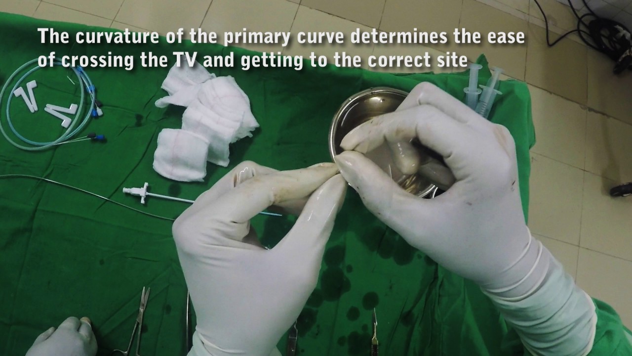 Creating the Three Dimensional Stylet for Right Ventricular Lead