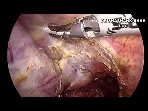 Bloodless Laparoscopic cholecystectomy with harmonic and vascular haemoclip, safe for MRI in future.