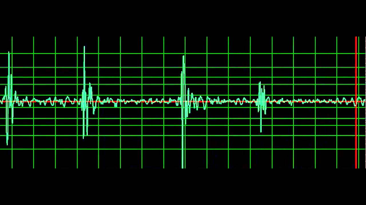 Prosthetic Mitral Valve Closing Click- normal speed