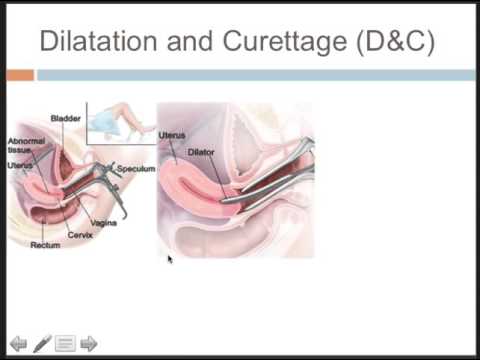 DAROGA Postmenopausal bleeding: part 2. Investigations to rule out or detect Endometrial Cancer