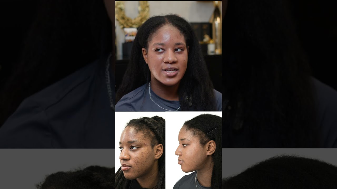 Sharon's Transformation Journey: Overcoming Hyperpigmentation with Este Medical