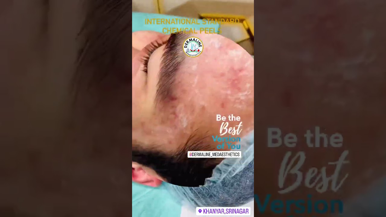 Salisalic 30% Pure Peel             #Startwithleaderma #chemicalpeel #peeling #salisalic