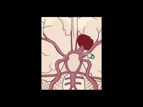 Neurosurgical clipping #aneurysm #shorts #anatomy #science