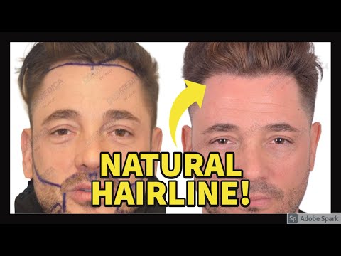 YOUR HAIR TRANSPLANT DOCTOR IS SCREWING YOU OVER IF HE DOESN'T DO THIS FOR YOU!