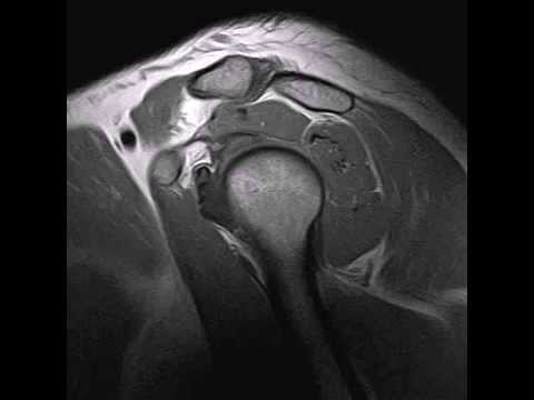 MRI Sagittal (Side) View of Left Shoulder, 400x400 Resolution, 24 Images