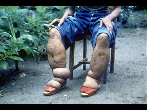 20 Rare Overseas Diseases