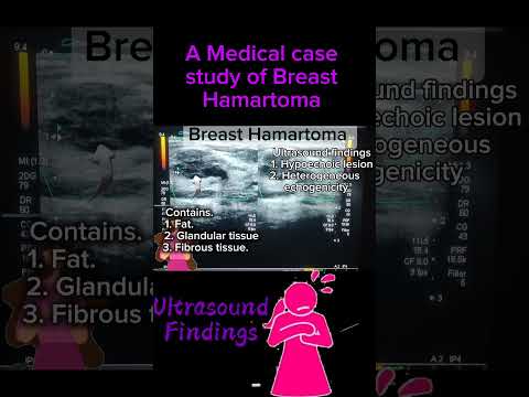 Benign Breast Tumors: Understanding case study of Hamartomas health #healthytips @Dr.Saimakhan
