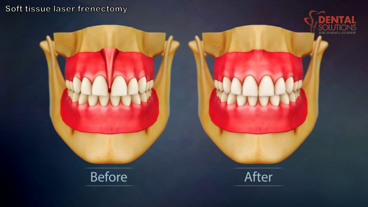 Soft tissue laser frenectomy for reducing gap between teeth