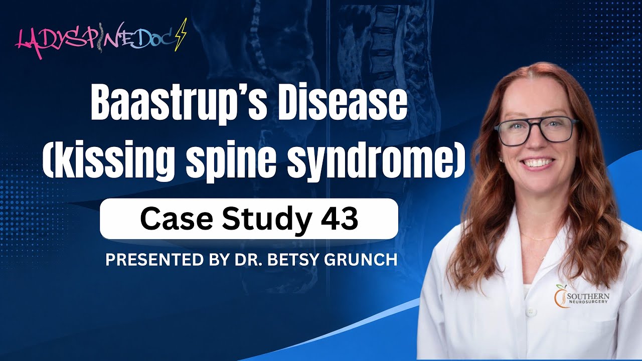Case study 43- Baastrup’s Disease (kissing spine syndrome) explained by board-certified neurosurgeon