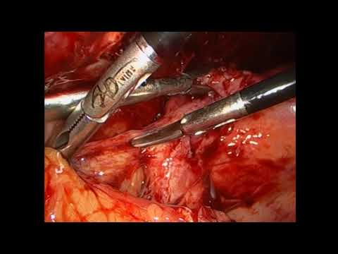 mucocele gallbladder with severe adhesions