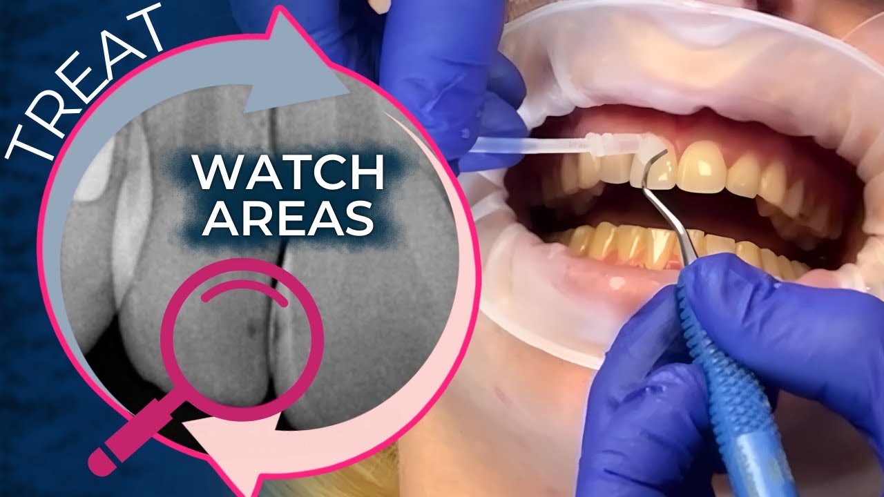 How to Apply Curodont Repair Fluoride Plus™: A Step-by-Step Guide