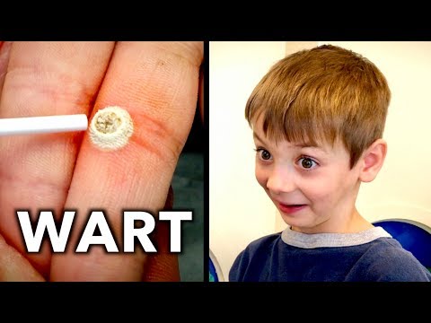 FREEZING OFF A BIG FINGER WART (This Kid is Really Brave) | Dr. Paul