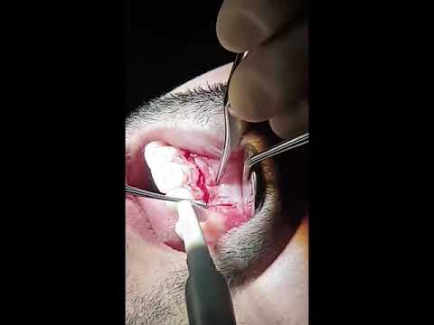 APICOECTOMY- Looking for the best APICOECTOMY clinic ? - Hayes Dental 0208 462 1347
