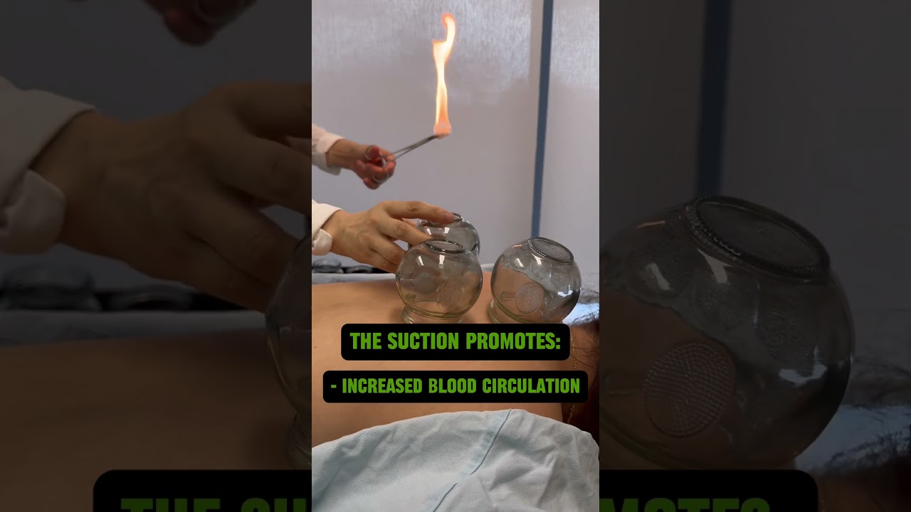 Traditional Chinese Medicine - Cupping