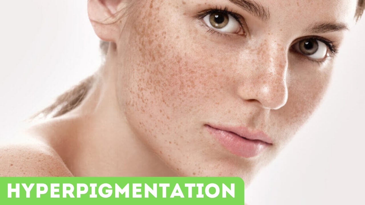 HYPERPIGMENTATION : Treatment, types, and causes