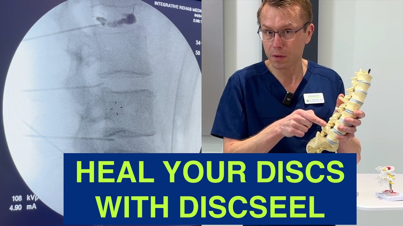 Revolutionizing Back Pain Treatment: The Discseel Procedure and PRP ...