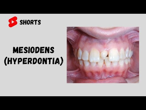 Mesiodens | Supernumerary Tooth