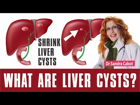 LIVER CYST - Symptoms | Natural Treatment | Diet | Supplements | Is a #livercyst Dangerous?