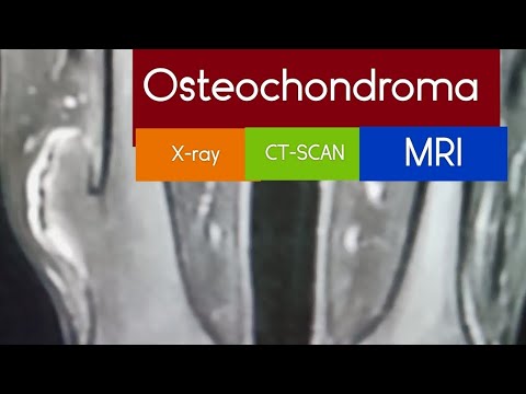Osteochondroma/ Exostosis - Benign bone pathology! on x-ray MRI and CT scan! #xray #mri #ctscan