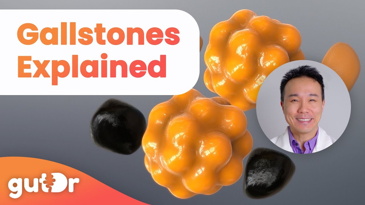 Understanding Gallstones: Causes, Symptoms, and Complications | Galaxy.ai