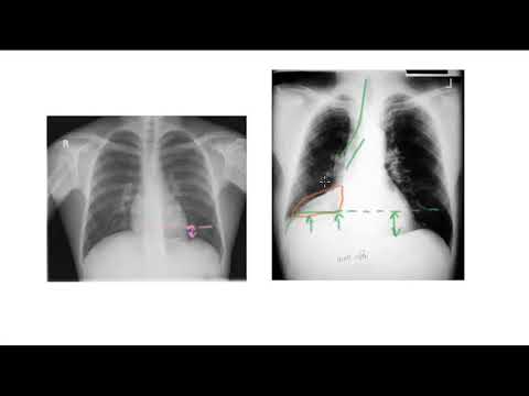 🔴 PNEUMONIA, PLEURISM, INFARCTION OR ATELECTASIA?!