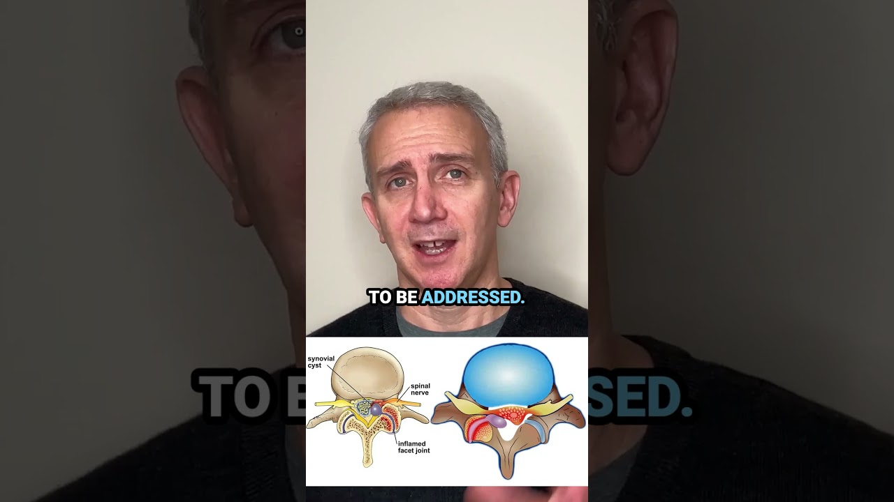 Can Spinal Cysts Cause Leg Pain? Understanding the Connection