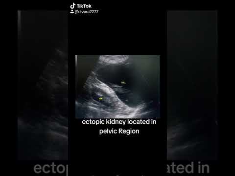 ectopic kidney located in pelvic region