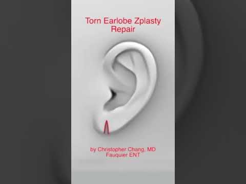 Torn Earlobe Z plasty Repair