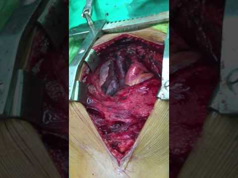 Completion of removal of the Malignant Thymoma