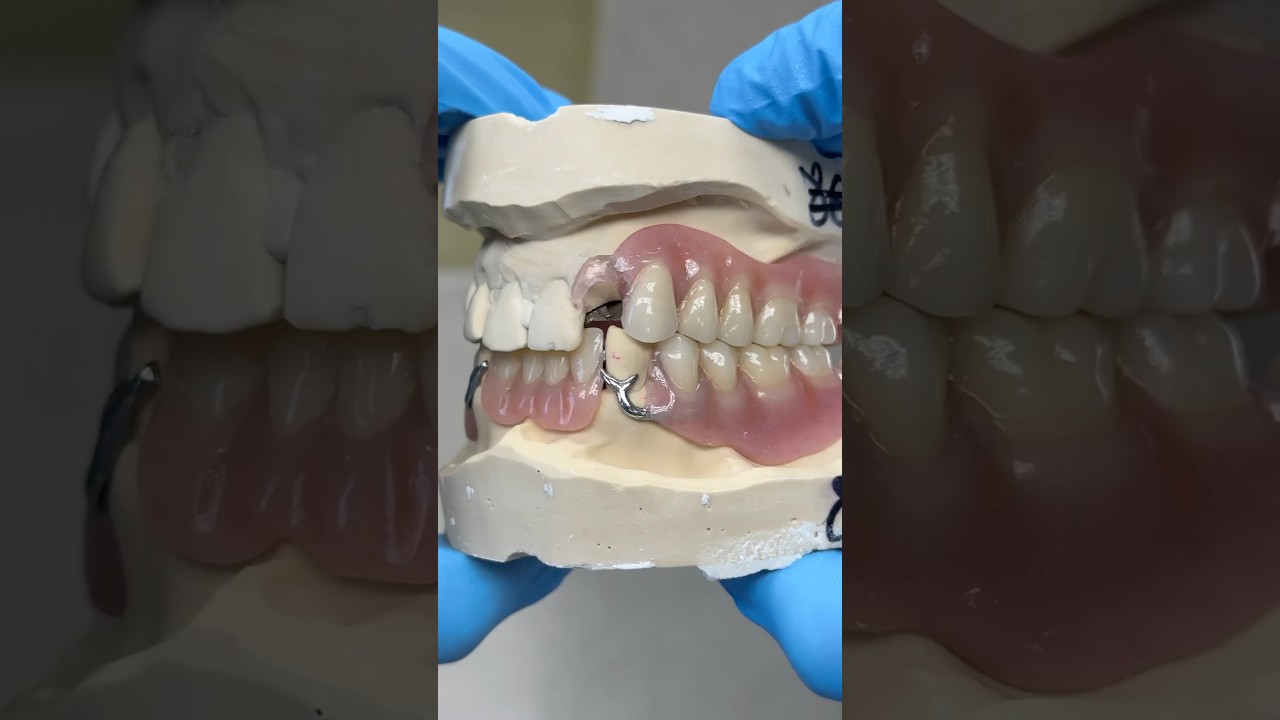 Chrome Cobalt Partials #lsk121shorts #dentist #teeth