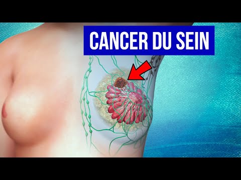 Cancer du Sein : Explications et traitements