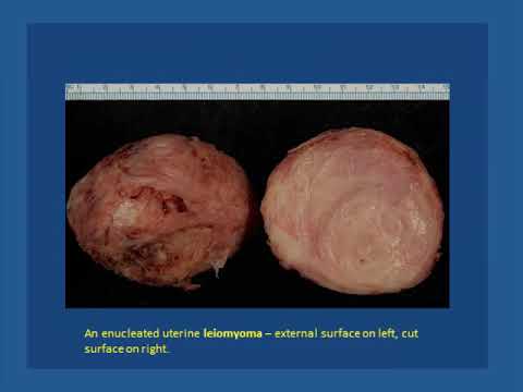 Uterine Fibroids and Voiding Dysfunction - A Real Concern or a Myth?