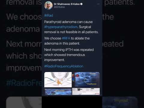 RFA of Parathyroid adenoma