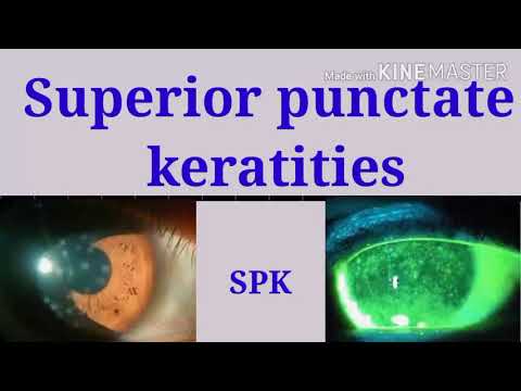 superficial punctate keratitis treatment | Superficial punctate keratitis grading | SPK | herpes zos