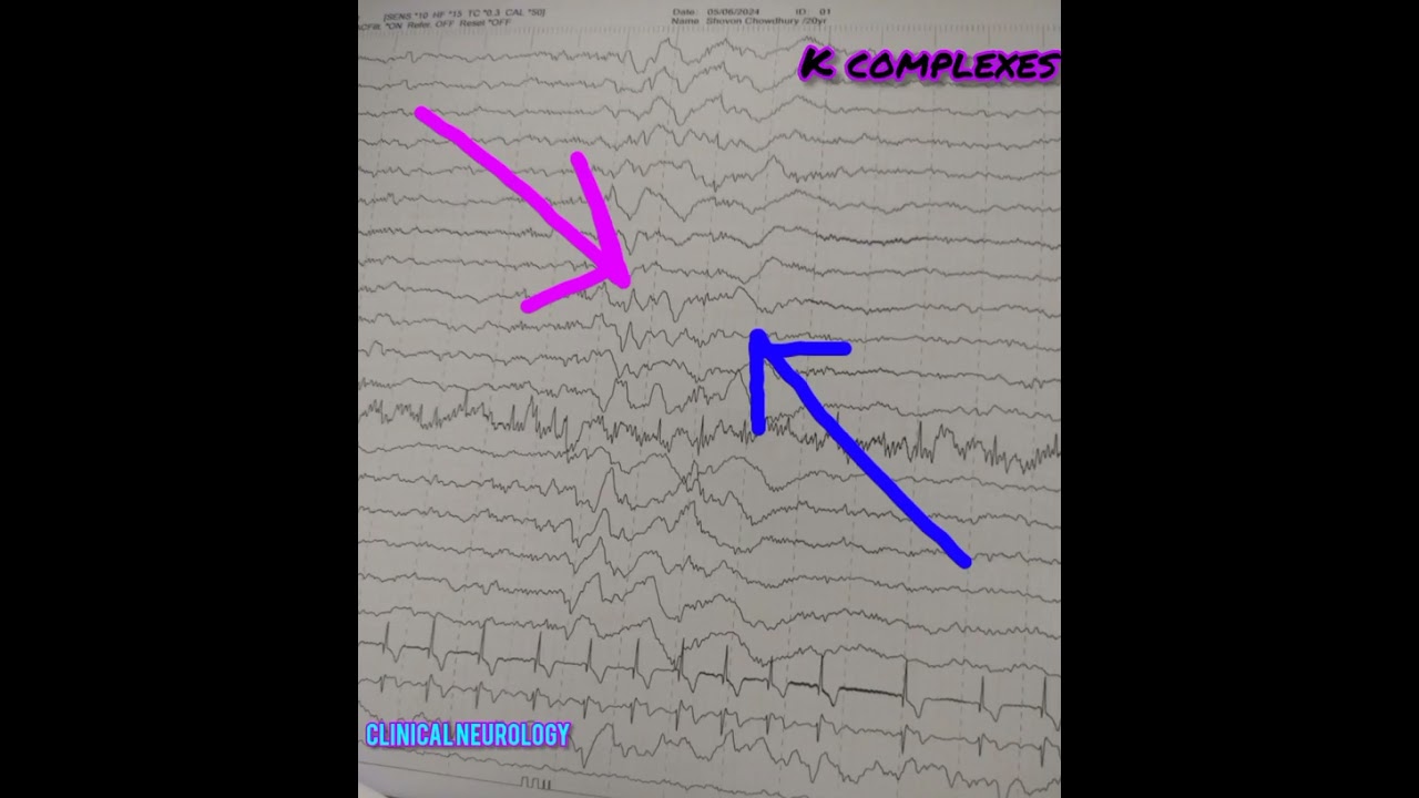 K Complexes EEG, #eeg #medicine #neurology