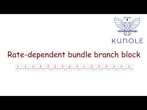 Bradycardias and conduction disorders (3.6). Rate-dependent bundle branch block