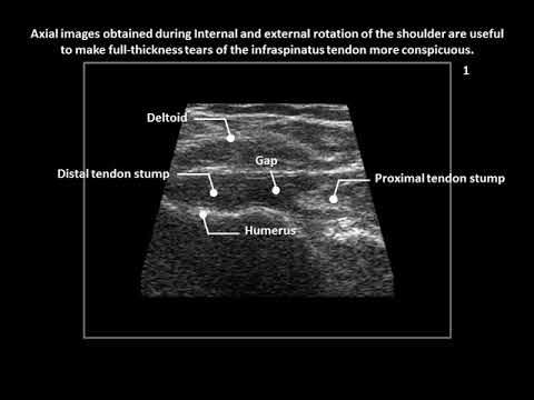 Full-thickness tear of the infraspinatus tendon on shoulder ultrasound