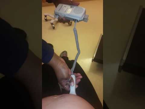 Baby heartbeat 144bpm
