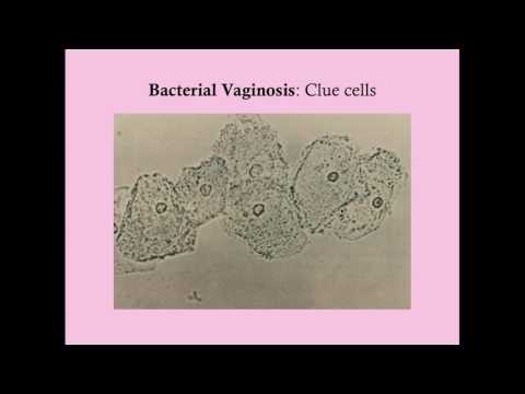 Bacterial Vaginosis in Pregnancy - CRASH! Medical Review Series