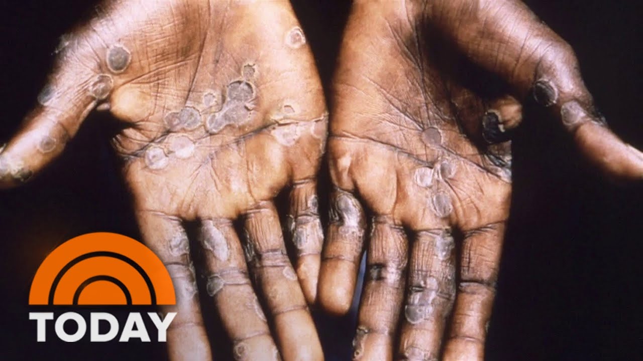 CDC Tracking 9 Cases Of Monkeypox Across 7 States