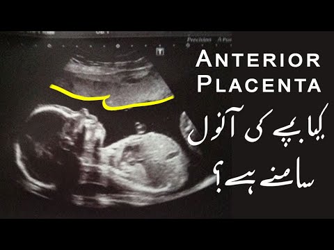 Anterior Placenta (Urdu/Hindi)