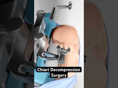 Correcting a bulging brain (Chiari Malformation)