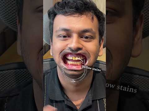 How Teeth Whitening Is Done with Perfora Purple Magic Serum | Purple Magic Test - Episode 1
