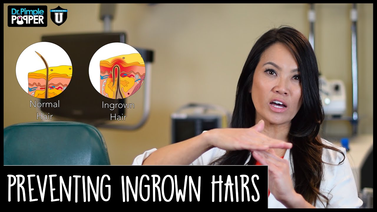 Preventing Ingrown Hairs - POP QUIZ!