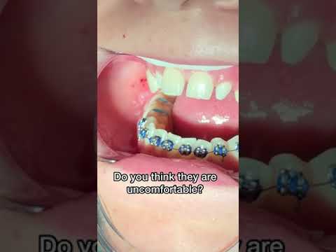 Spacers for Braces - Ouch - Tooth Time Family Dentistry New Braunfels
