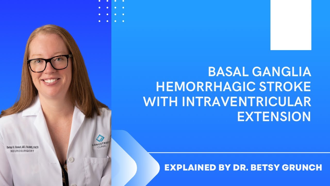 Case study 49 - Basal Ganglia Hemorrhagic Stroke with Intraventricular Extension