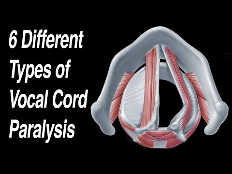 Vocal Cord Paralysis: 6 Different Types of Paralysis and How It Looks/Moves