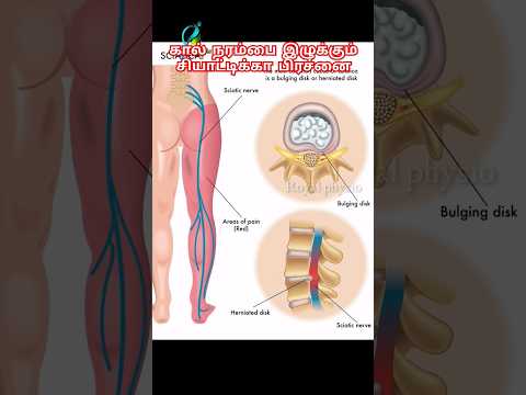 சியாட்டிக்கா பிரச்னை | sciatica pain relief exercises in tamil | leg pain relief in tamil | physio
