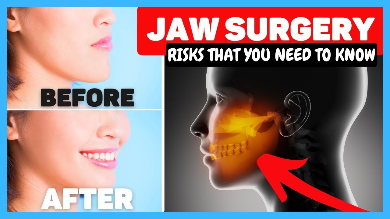Corrective Jaw Surgery Recovery & Cost {Dentist REVIEW of Orthognathic Surgery}