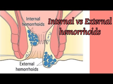 Internal & External Hemorrhoids (Piles) I @DrAshishSachan